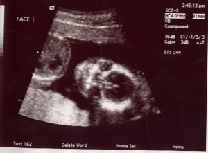 12 Creepy and Disturbing Baby Ultrasounds - Riot Daily